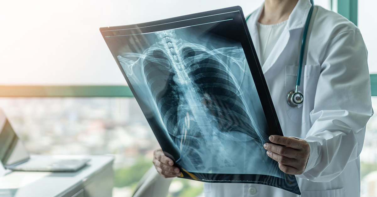 Post-Thoracotomy Pain Syndrome | MedStar Health