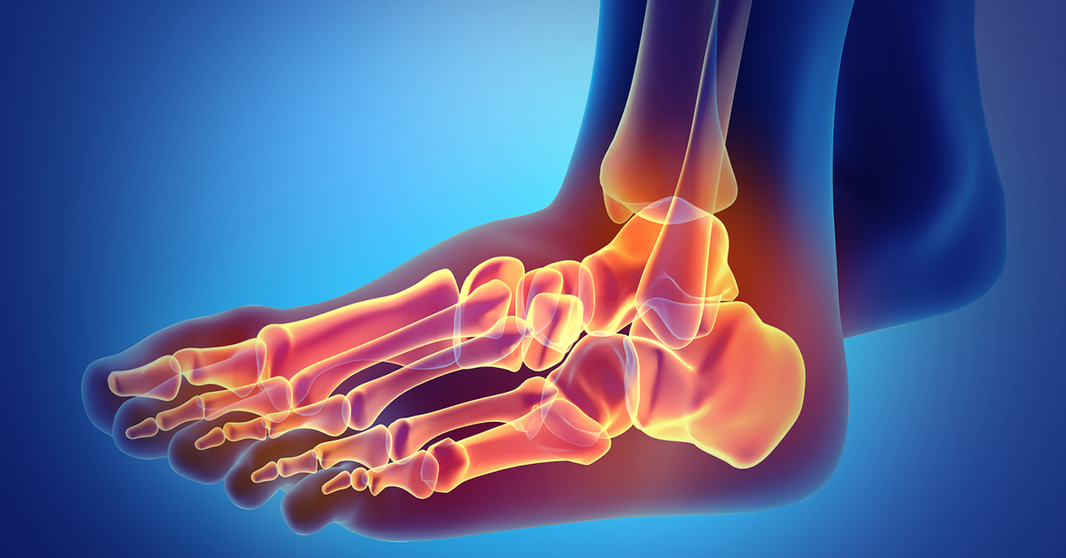Metatarsal Osteotomy | Types of Foot Treatments | MedStar Health